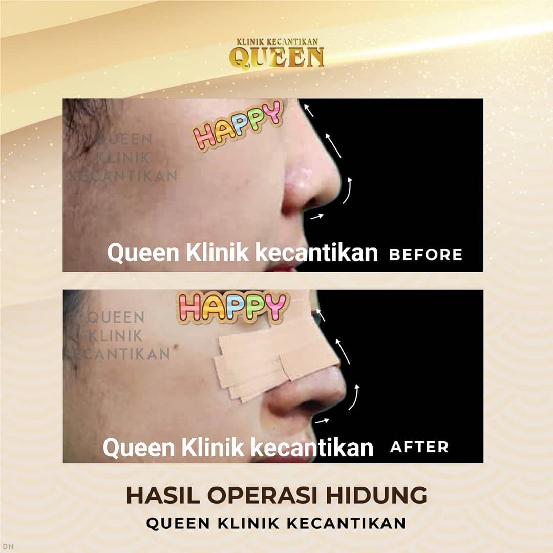 Before After Operasi Hidung - Klinik Bedah Plastik Queen