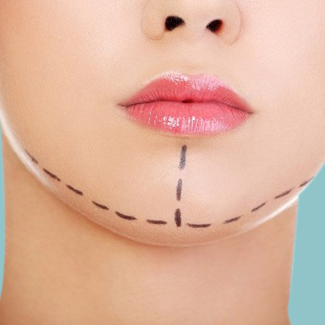 Revisi Dagu Ganti Implan - Queen Plastic Surgery