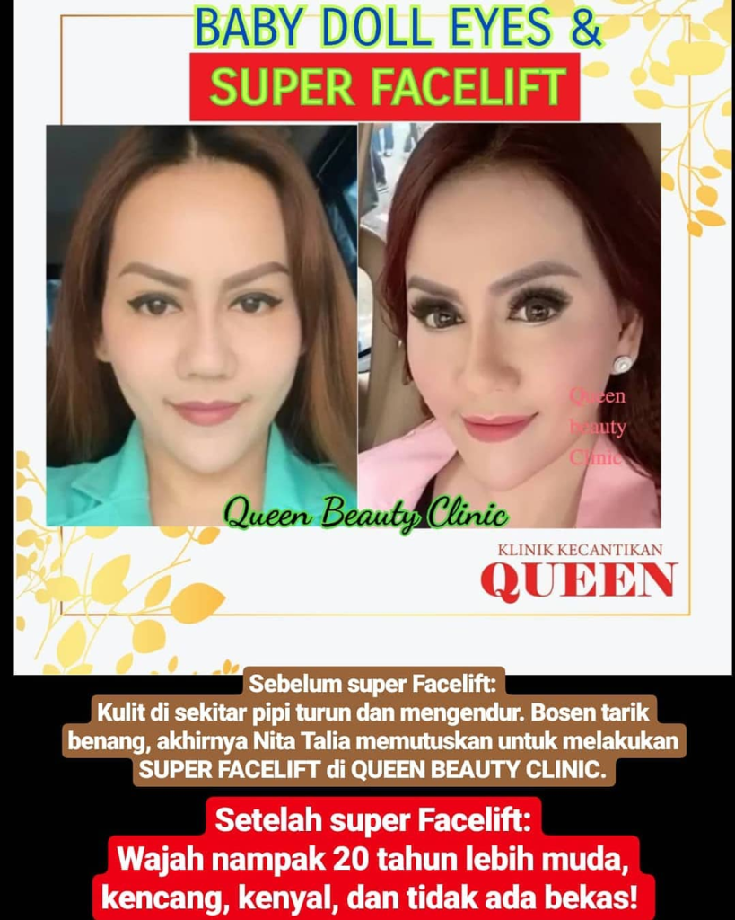 Operasi Super Face Lift Full Dan Neck - Klinik Bedah Plastik Queen