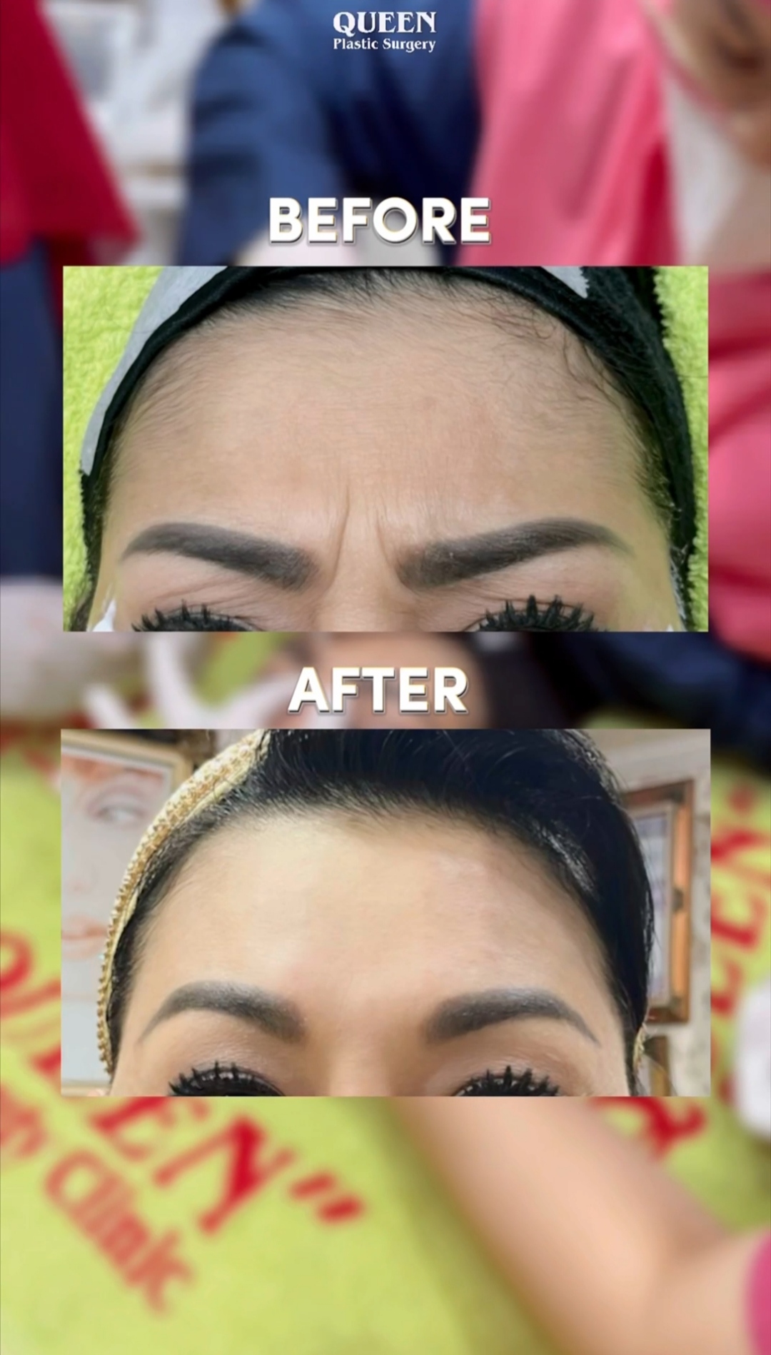 EFEK BOTOX JANGKA PANJANG - Klinik Bedah Plastik Queen