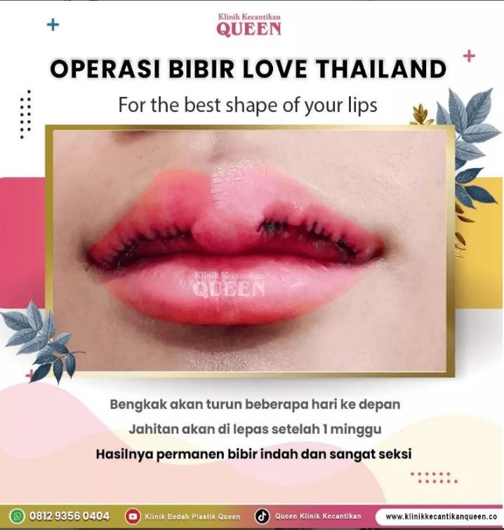 Klinik Kecantikan Queen Memberikan Tampilan Seksi Pada Operasi Bibir ...