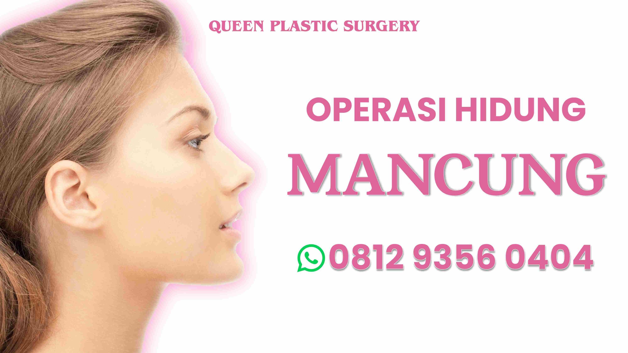 OPERASI HIDUNG MANCUNG - Klinik Bedah Plastik Queen