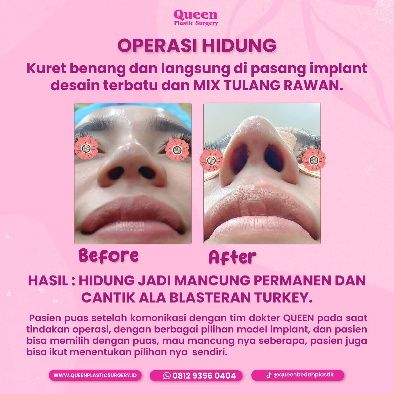 Cari Tahu Rhinoplasty Dengan Tulang Rawan Bersifat Permanen Atau Tidak ...