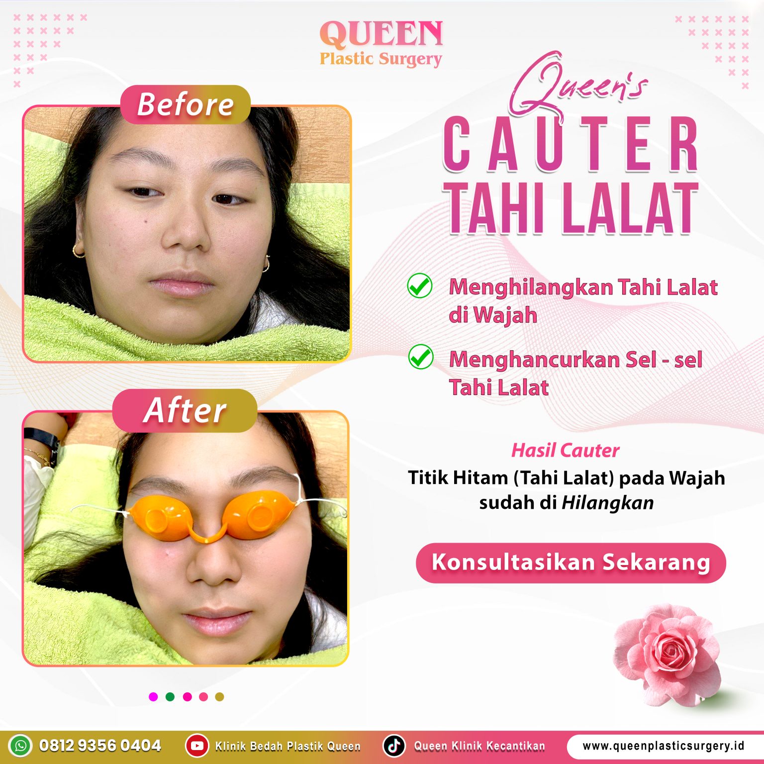 Perbedaan Tahi Lalat dan Skin Tag Yang Harus Diketahui Dengan Benar ...