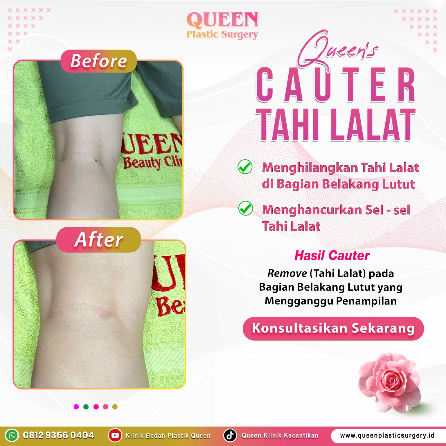 Perbedaan Tahi Lalat dan Skin Tag Yang Harus Diketahui Dengan Benar ...