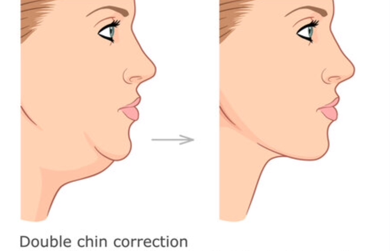 PERAWATAN TERBAIK UNTUK DOUBLE CHIN - Klinik Bedah Plastik Queen