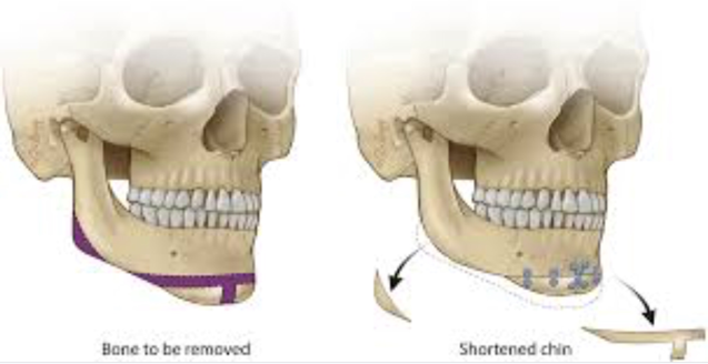 AUGMENTASI DAGU : IMPLAN DAGU ATAU GENIOPLASTY - Klinik Bedah Plastik Queen
