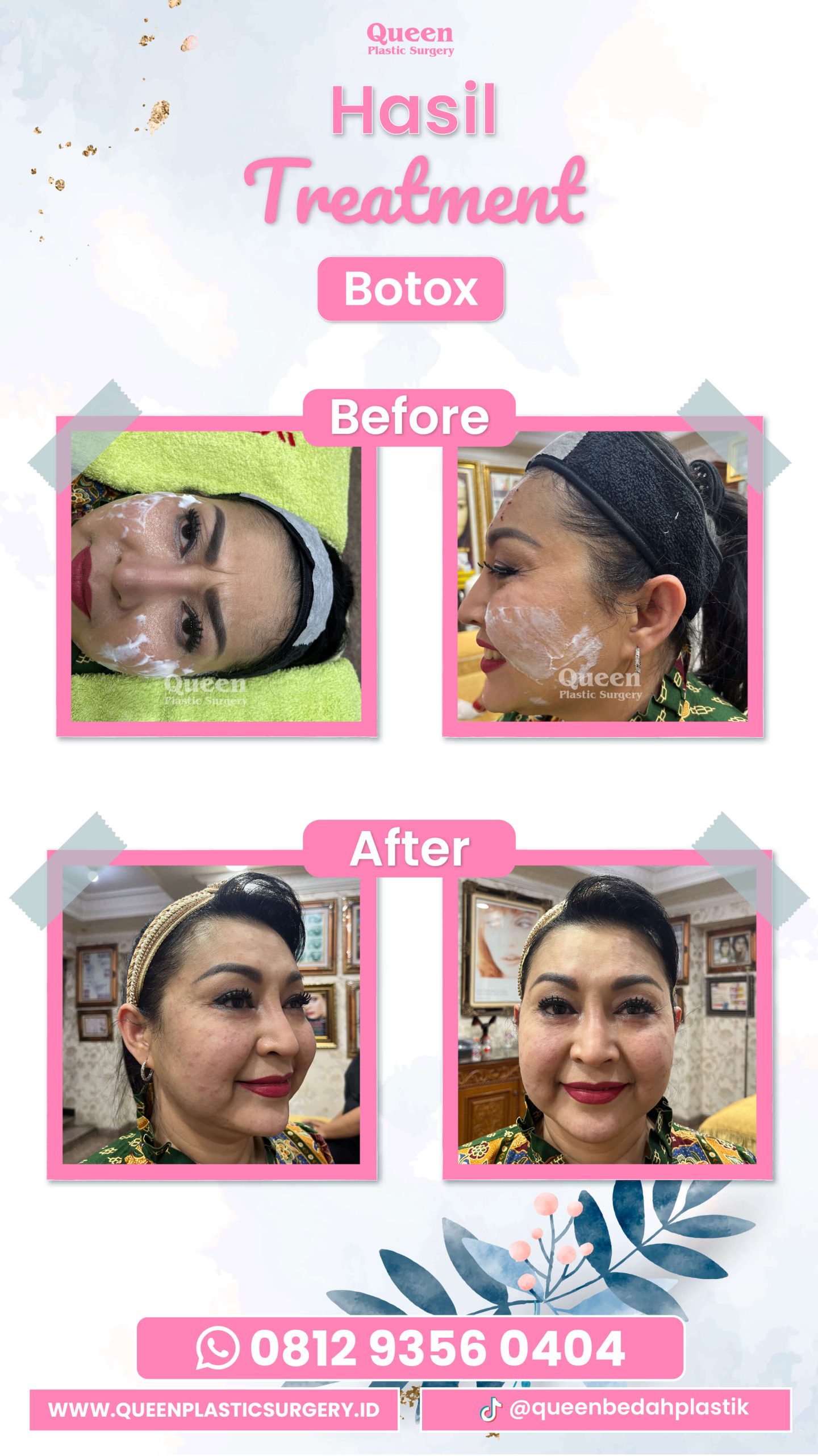 APA ITU “SMOKER’S LINES“ DAN PERAWATANNYA - Klinik Bedah Plastik Queen