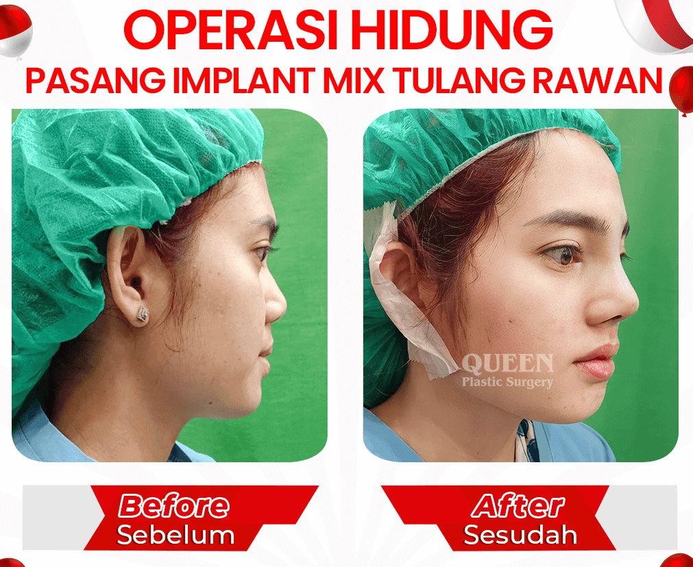 Arahan Yang Benar Untuk Melakukan Operasi Bedah Plastik Pada Remaja Era ...