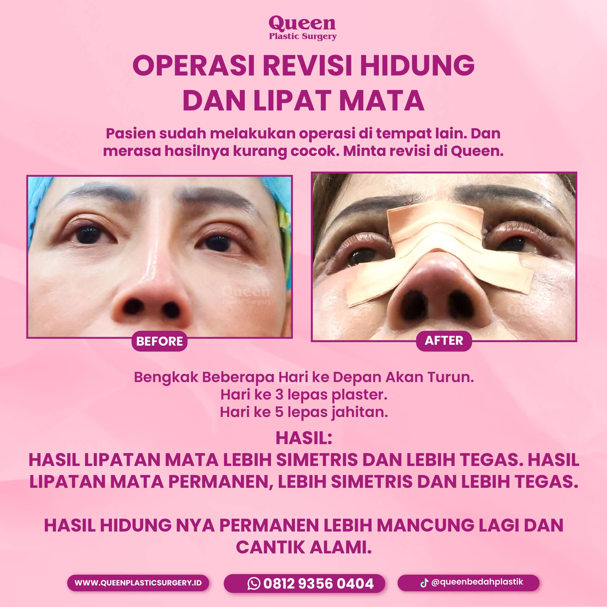 Operasi Hidung Rhinoplasty - Klinik Bedah Plastik Queen
