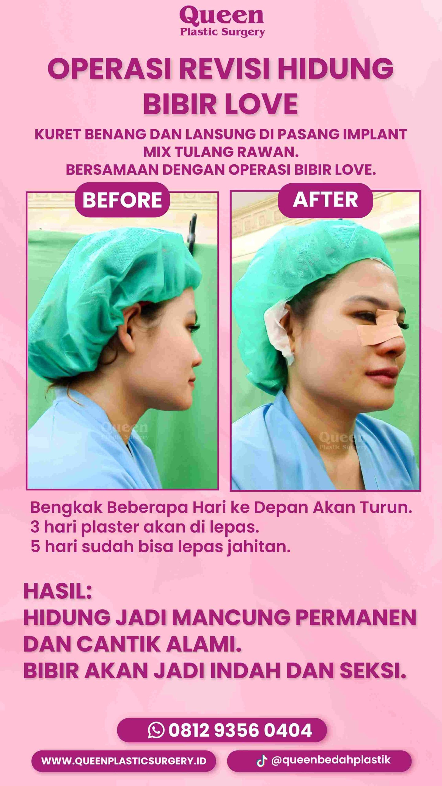 Operasi Hidung Rhinoplasty - Queen Plastic Surgery