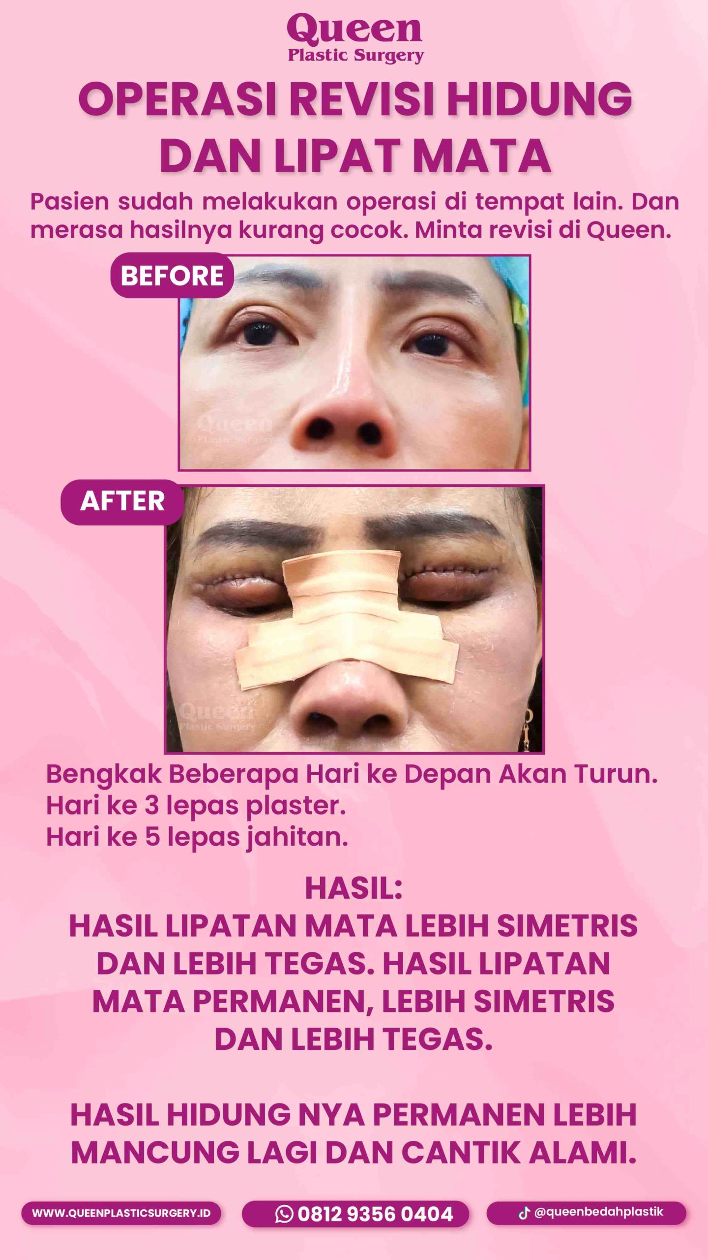 Operasi Hidung Rhinoplasty - Queen Plastic Surgery