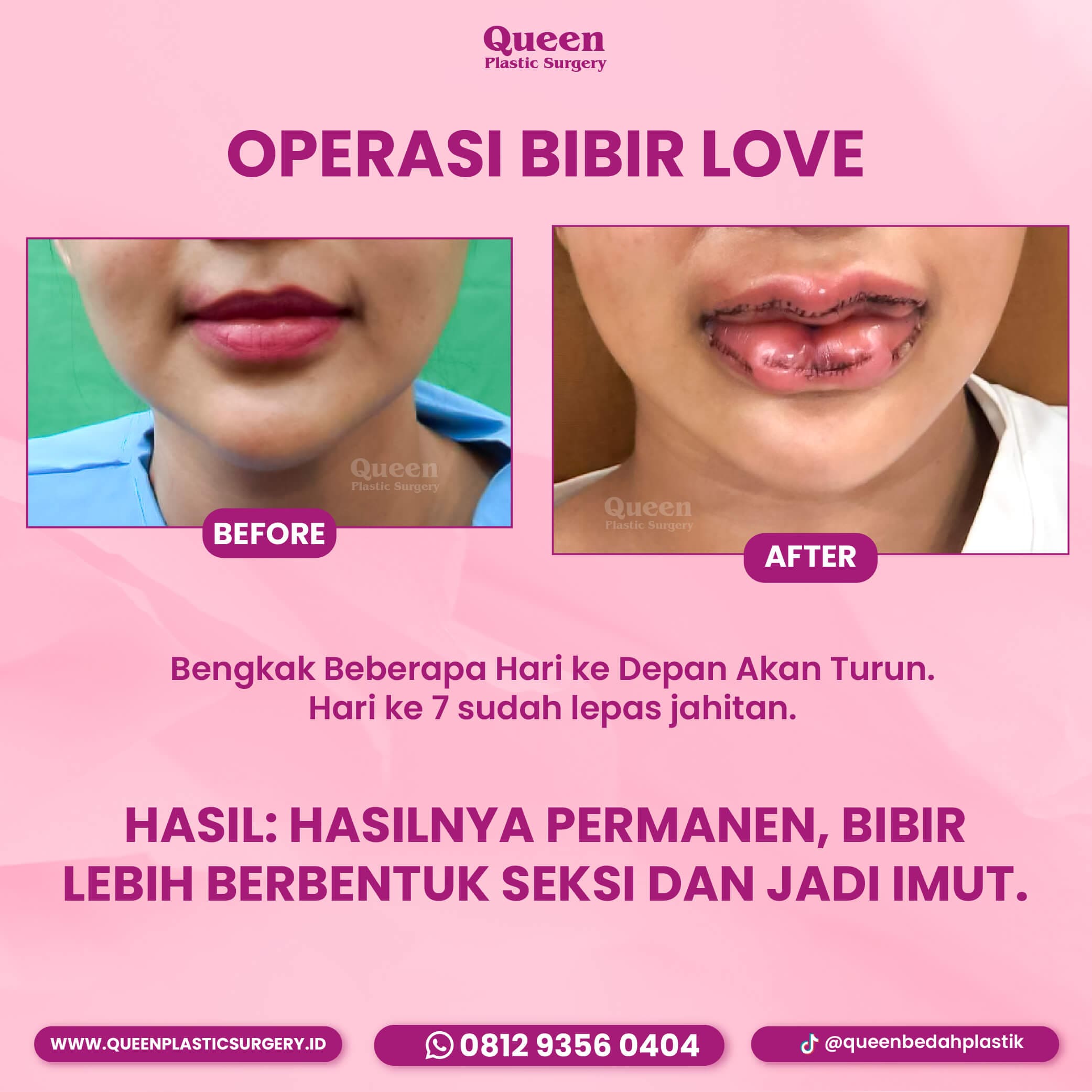 Lips Surgery - Klinik Bedah Plastik Queen