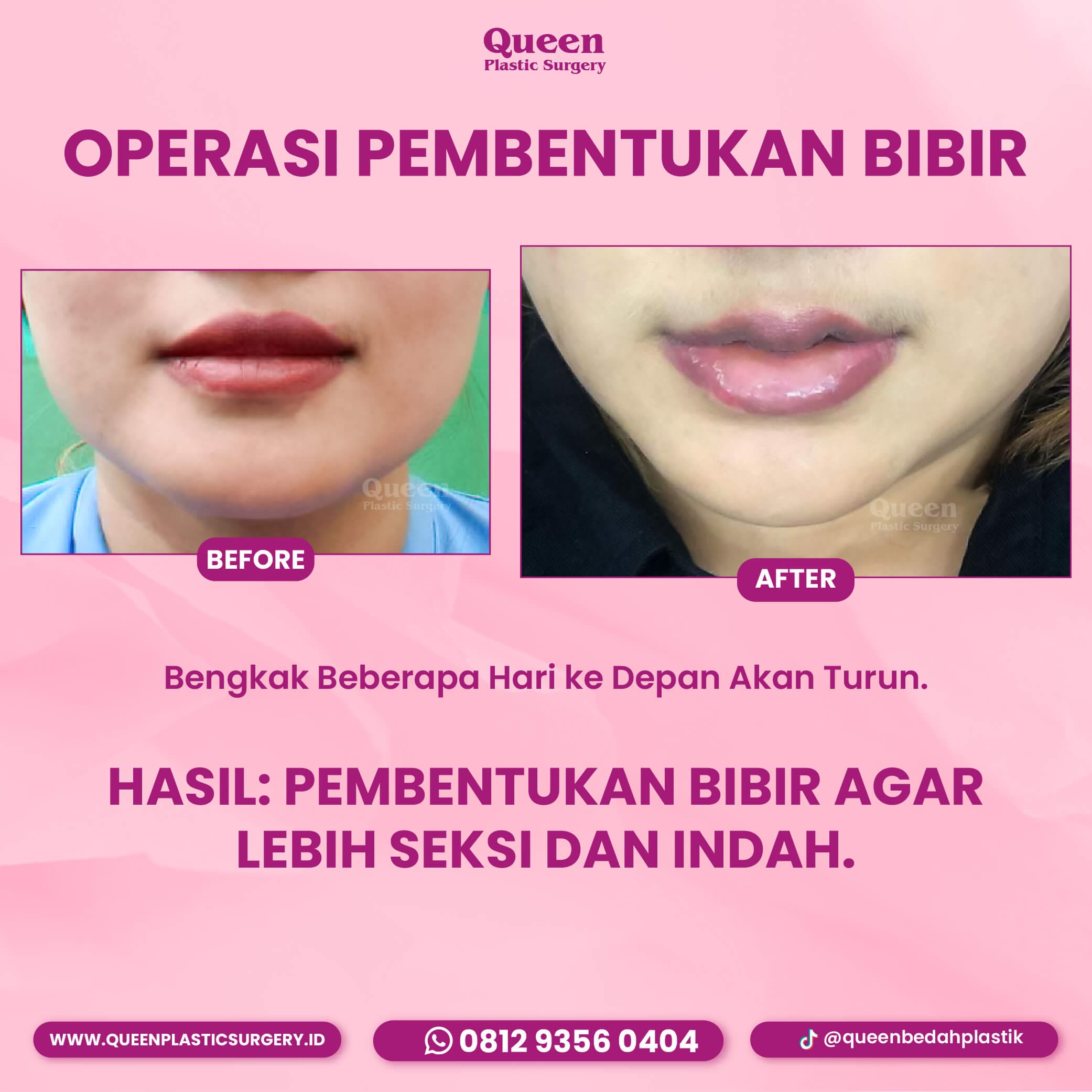 Lips Surgery - Klinik Bedah Plastik Queen