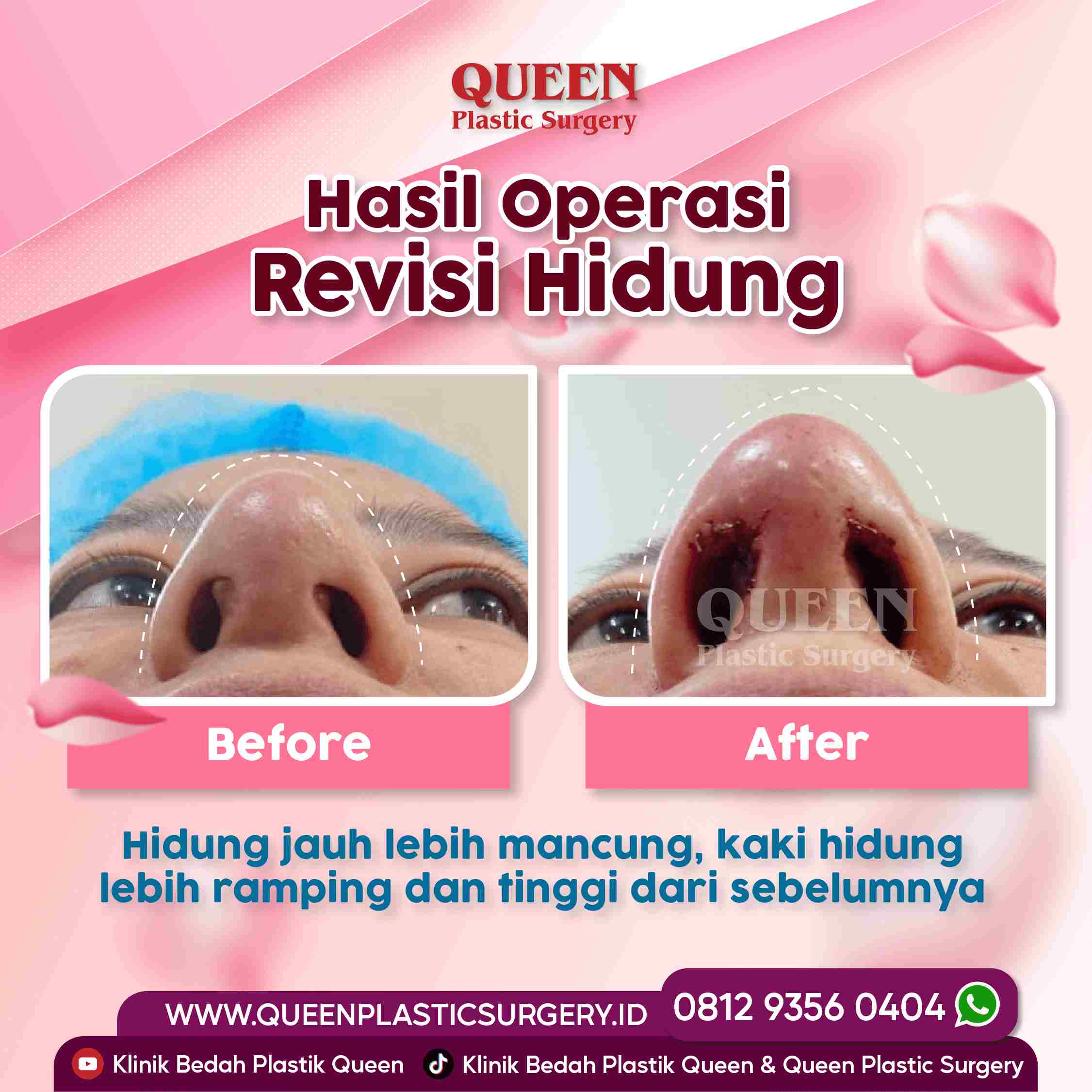 Operasi Hidung Rhinoplasty - Klinik Bedah Plastik Queen