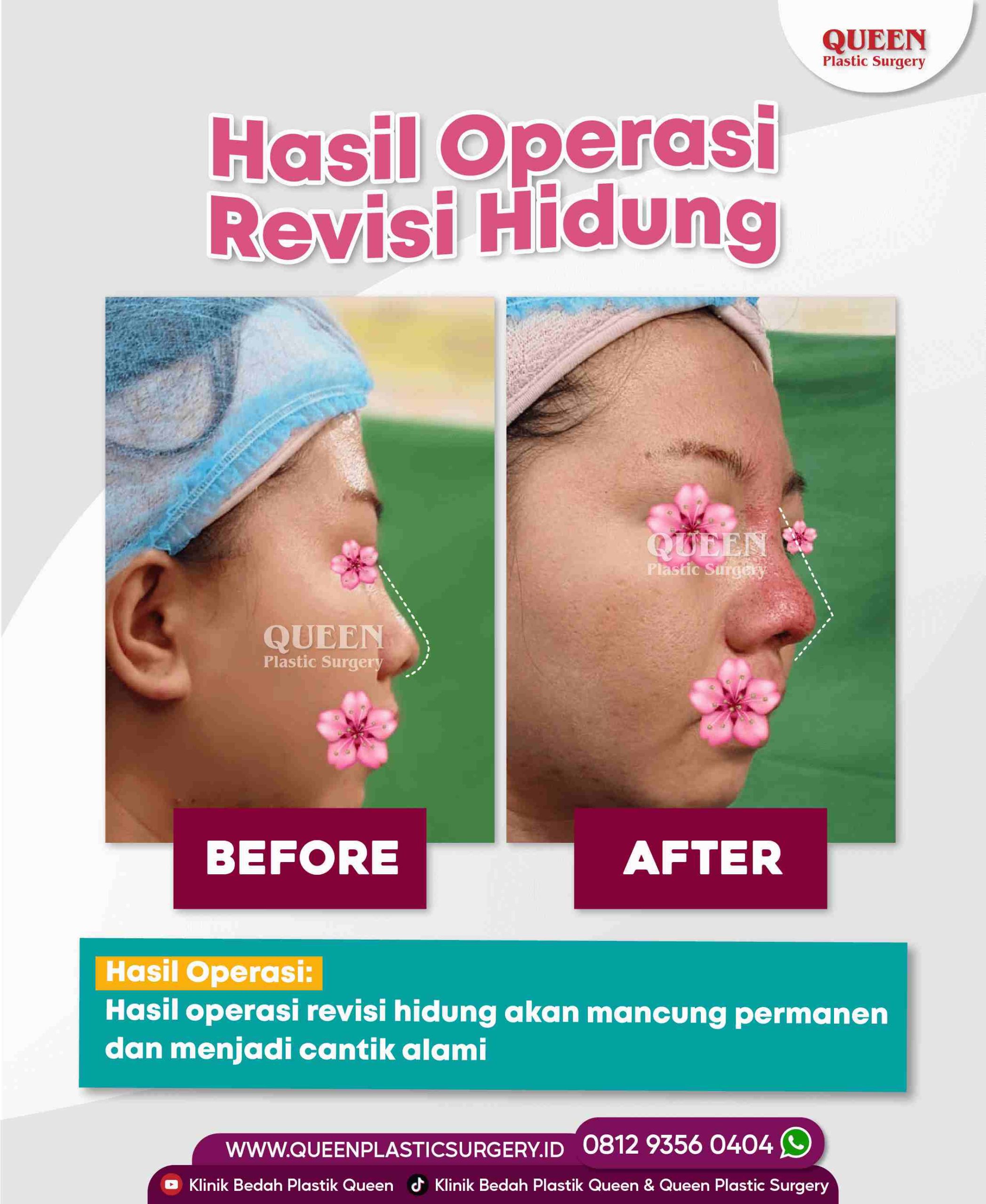Operasi Hidung Rhinoplasty - Queen Plastic Surgery