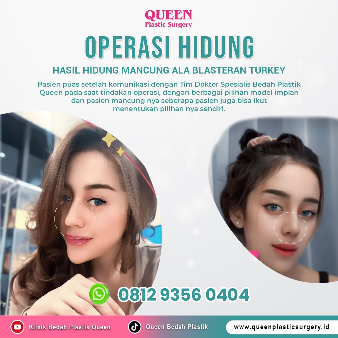Operasi Hidung Rhinoplasty - Klinik Bedah Plastik Queen