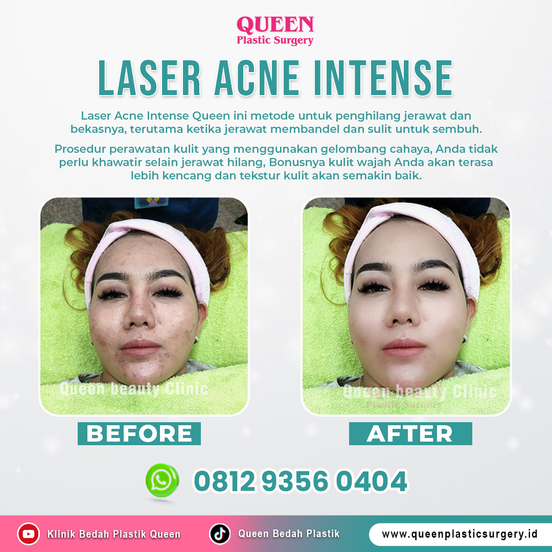 BEFORE AFTER PASIEN OPERASI PLASTIK - Klinik Bedah Plastik Queen