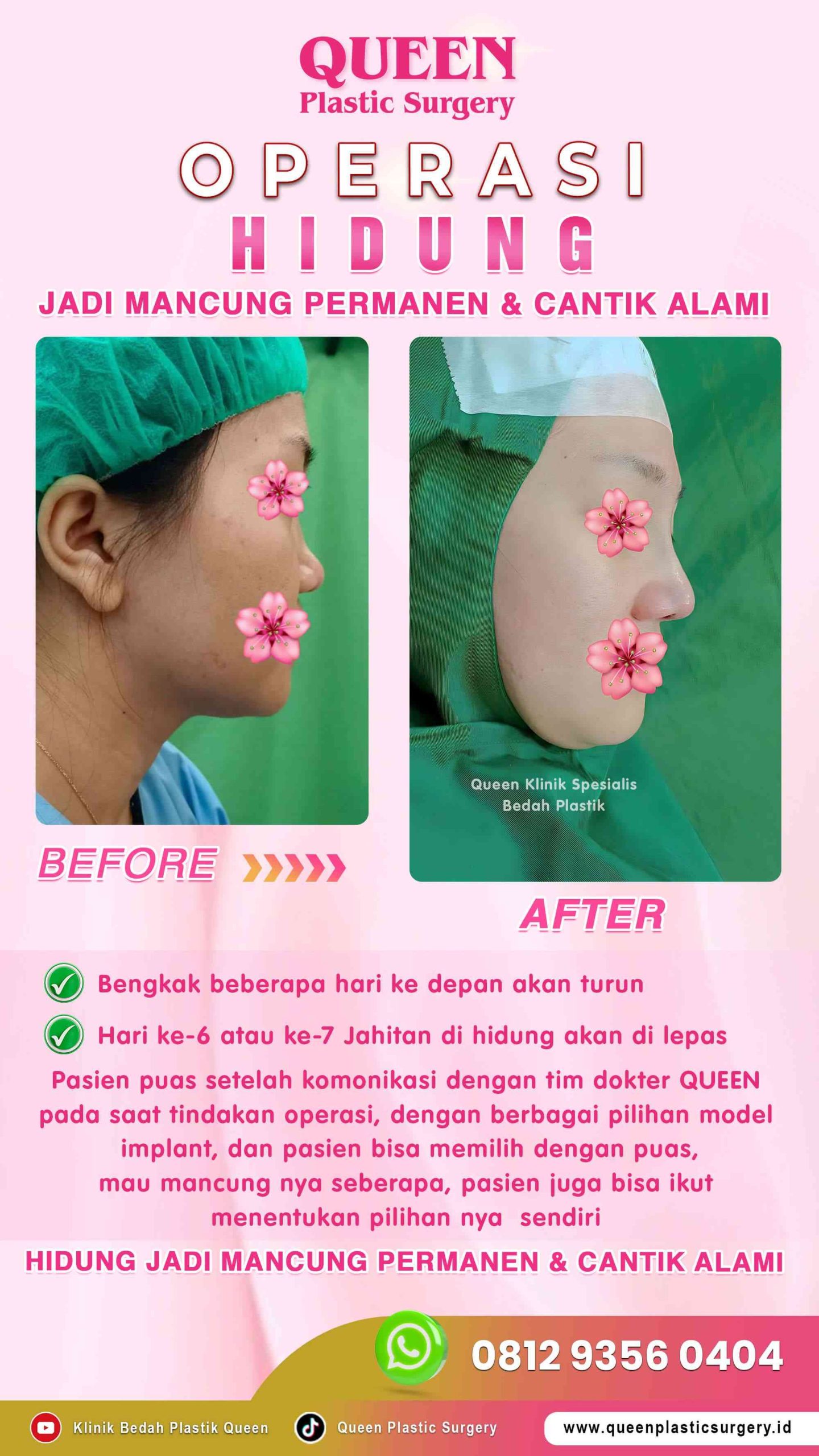 Queen Plastic Surgery: Operasi Hidung Terbaik di Indonesia - Klinik ...