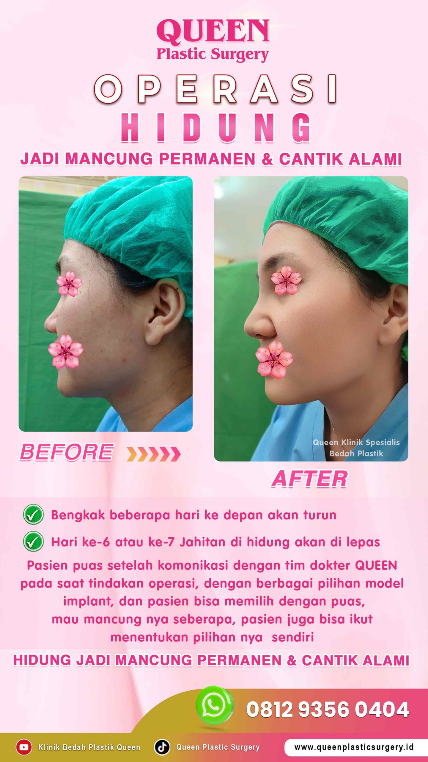 Rekomendasi Operasi Hidung dari Ahli di Queen Plastic Surgery - Klinik ...