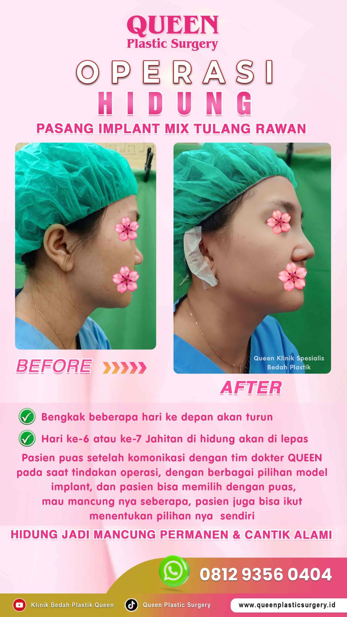Biaya Operasi Hidung di Jakarta di Queen Plastic Surgery yang ...
