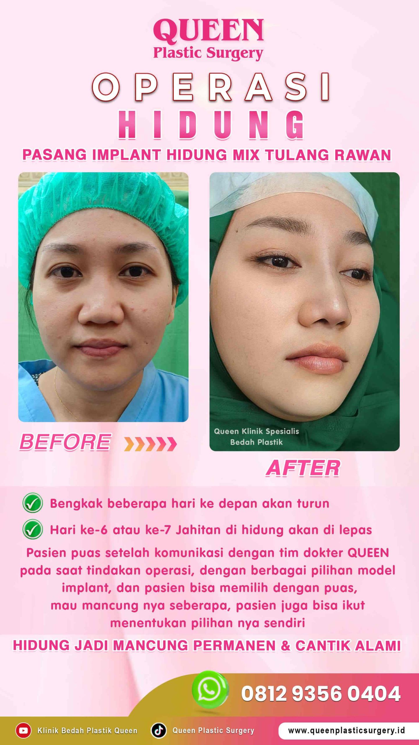 Implan Hidung di Queen Plastic Surgery - Klinik Bedah Plastik Queen