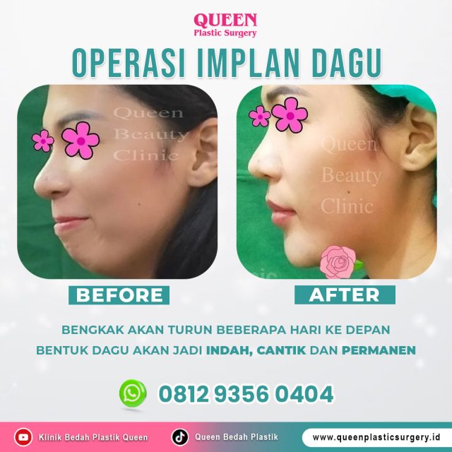 BEFORE AFTER PASIEN OPERASI PLASTIK - Klinik Bedah Plastik Queen