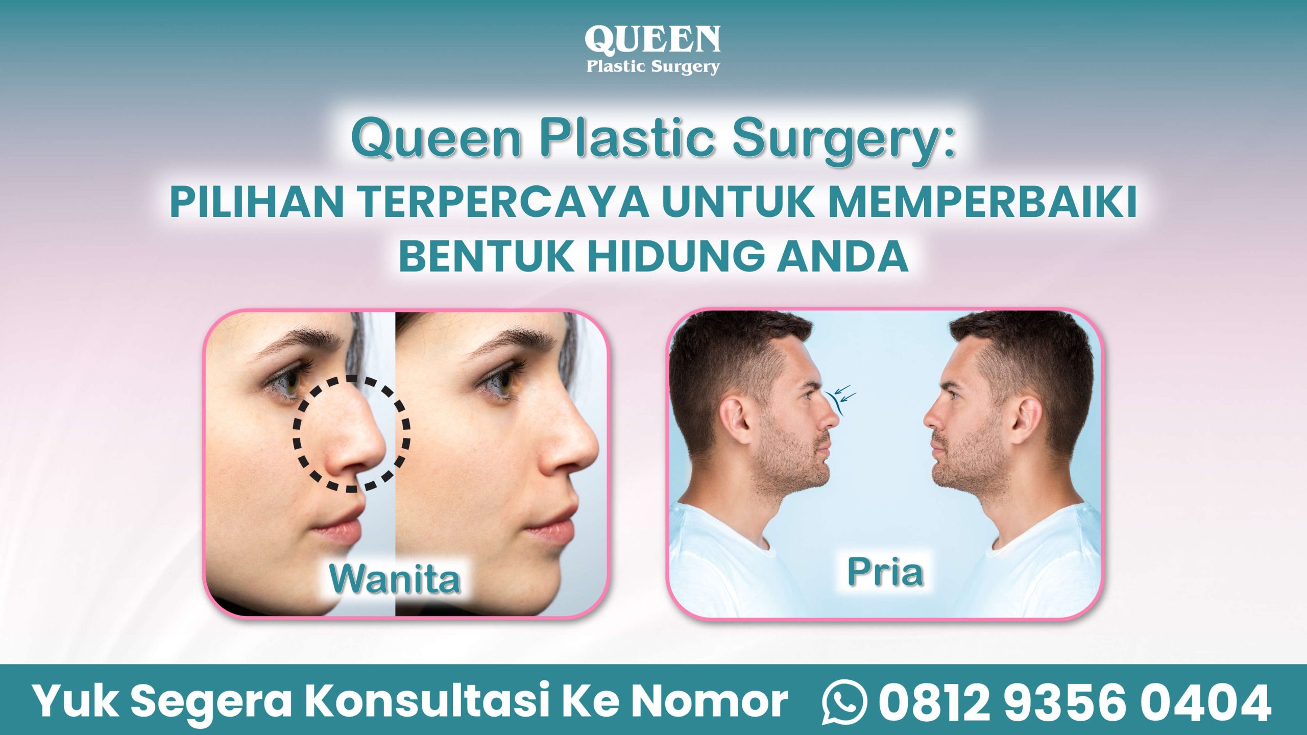 PROSEDUR RHINOPLASTY DAN HASIL YANG TERLIHAT ALAMI - Klinik Bedah ...