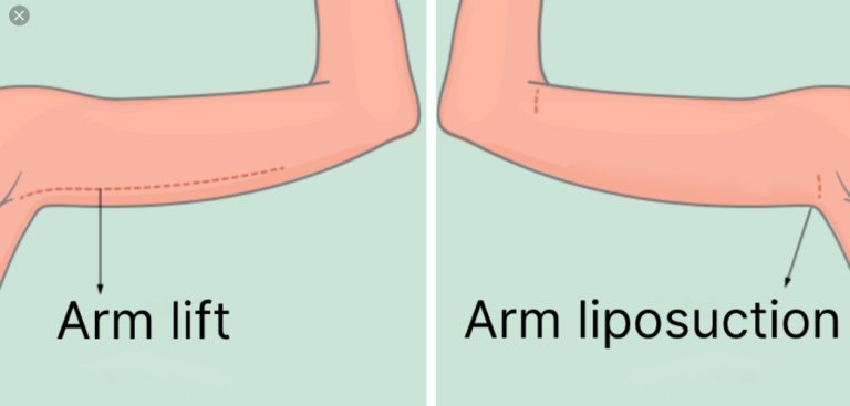 ARM LIFT (BRACHIOPLASTY) DAN ARM LIPOSUCTION - Klinik Bedah Plastik Queen