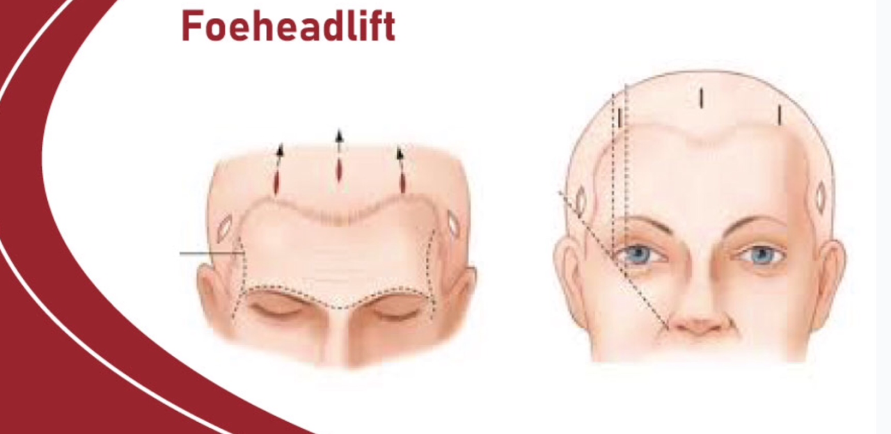 TAMPILAN MUDA DAN SEGAR DENGAN FOREHEAD LIFT - Klinik Bedah Plastik Queen
