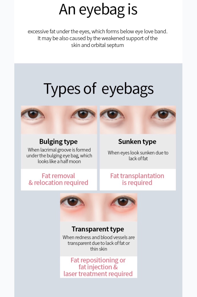 JENIS KANTUNG MATA. BAGAIMANA CARA MENGATASINYA? - Klinik Bedah Plastik ...