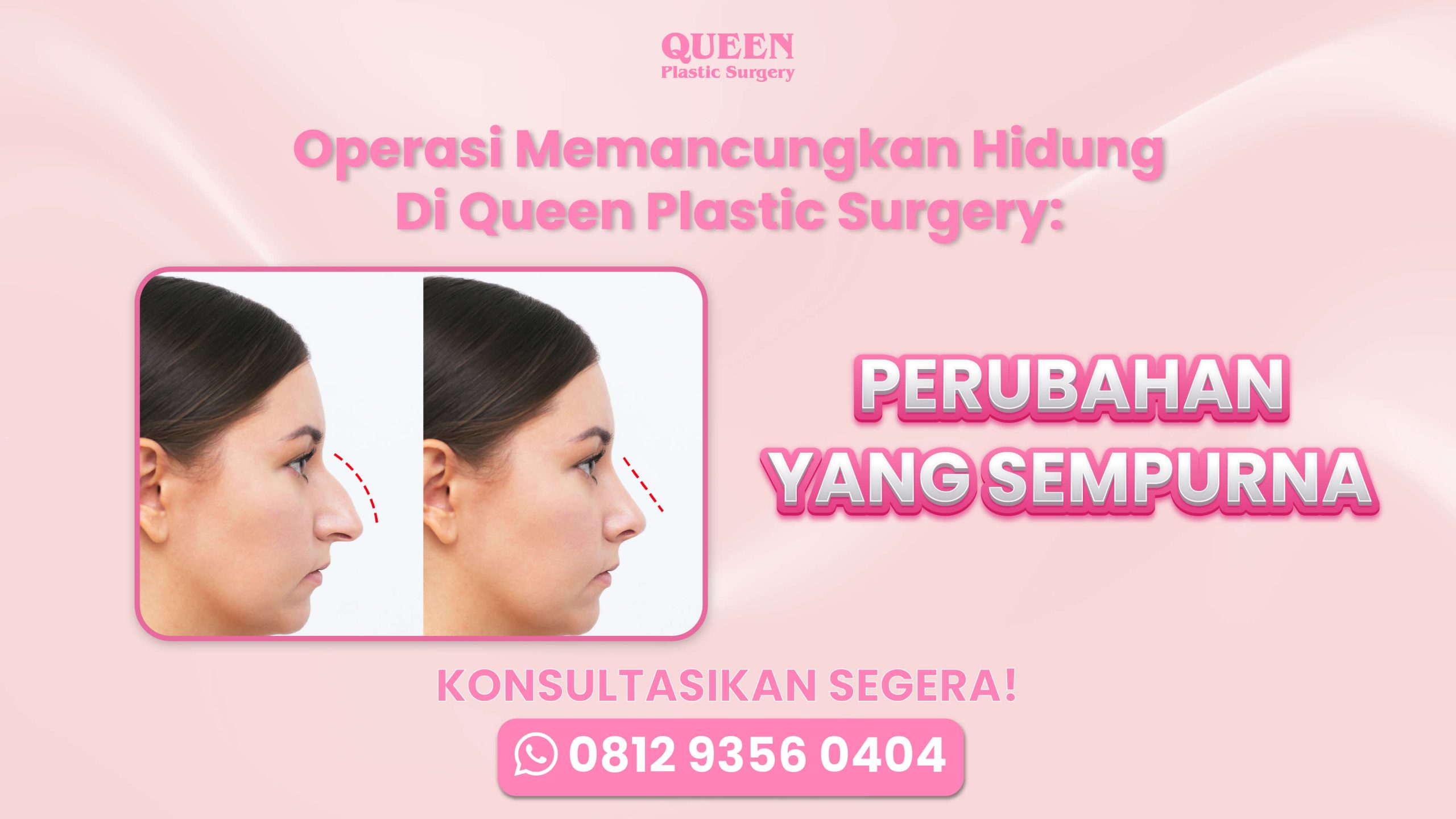 Mengintip Proses Operasi Memancungkan Hidung - Klinik Bedah Plastik Queen