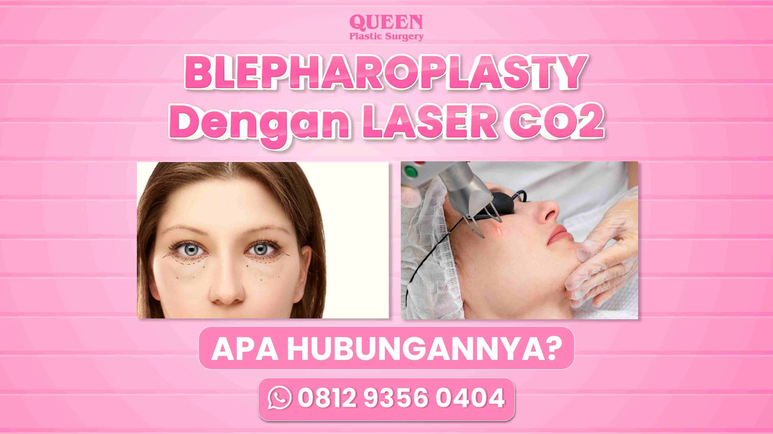BLEPHAROPLASTY DENGAN LASER CO2 - Klinik Bedah Plastik Queen