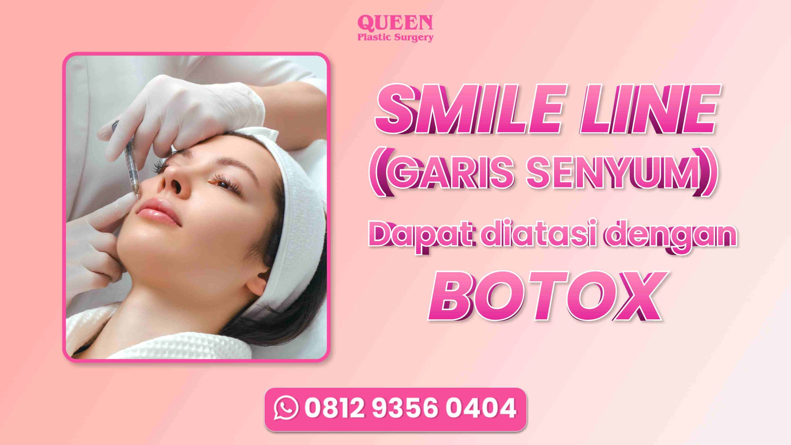 SMILE LINE DAPAT DIATASI DENGAN BOTOX - Klinik Bedah Plastik Queen