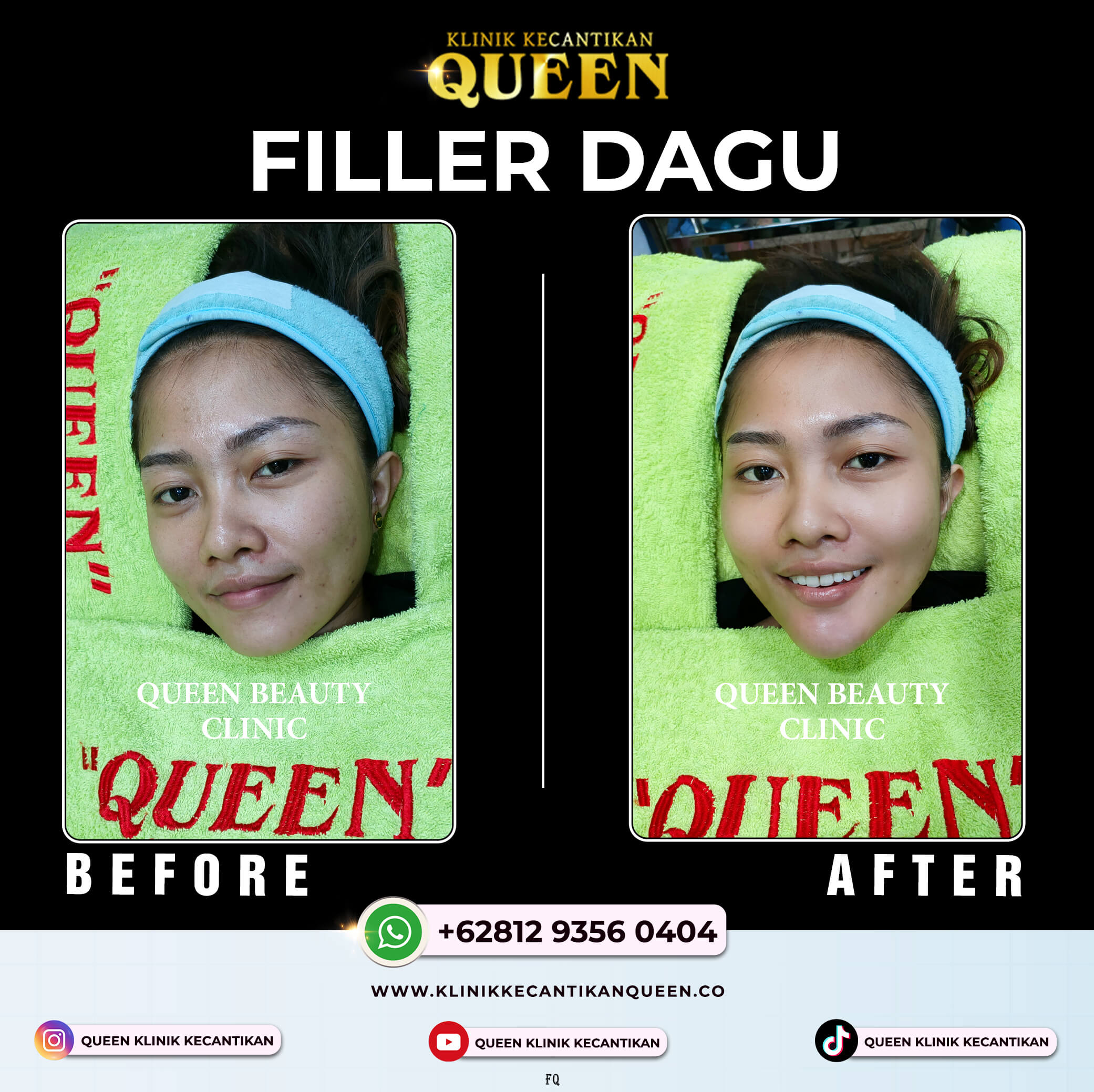 Filler - Klinik Bedah Plastik Queen