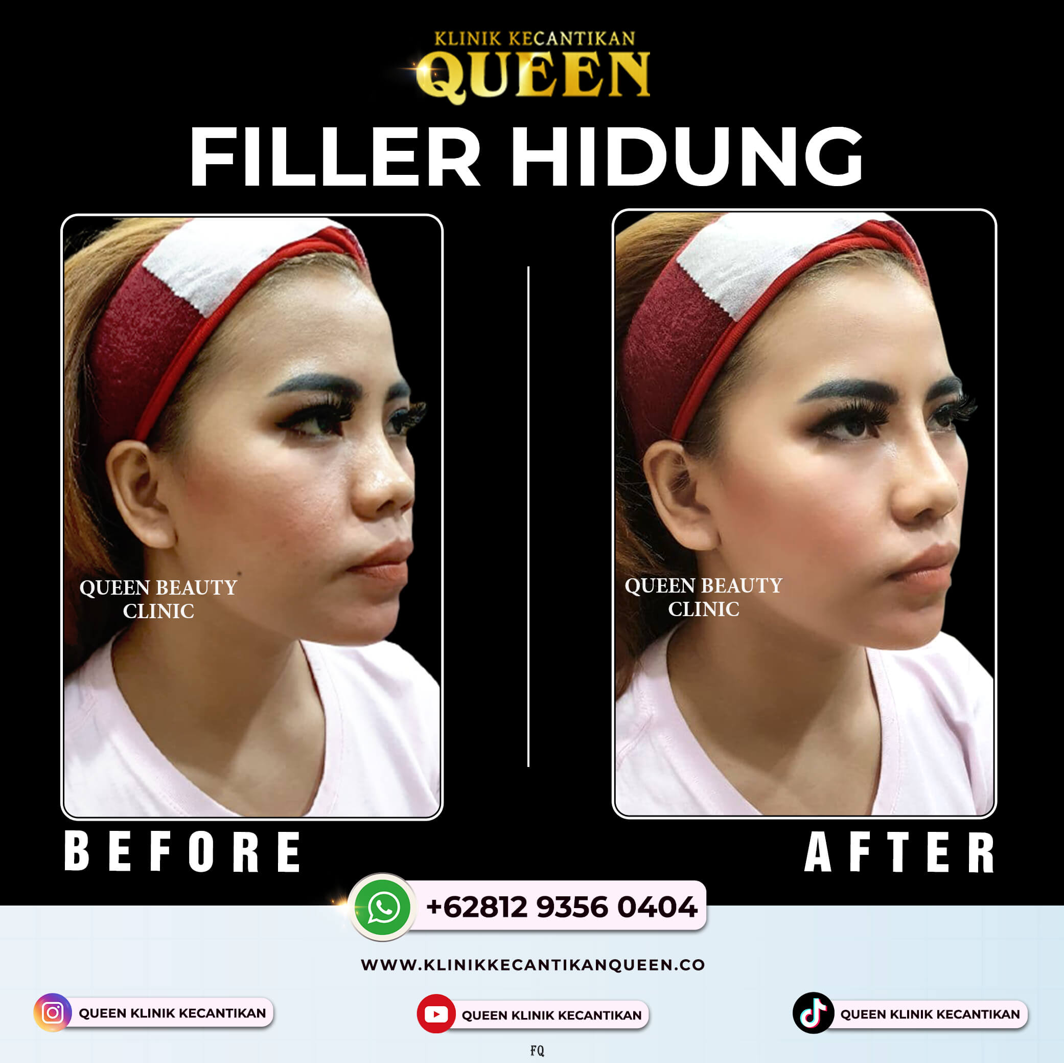 Filler - Klinik Bedah Plastik Queen