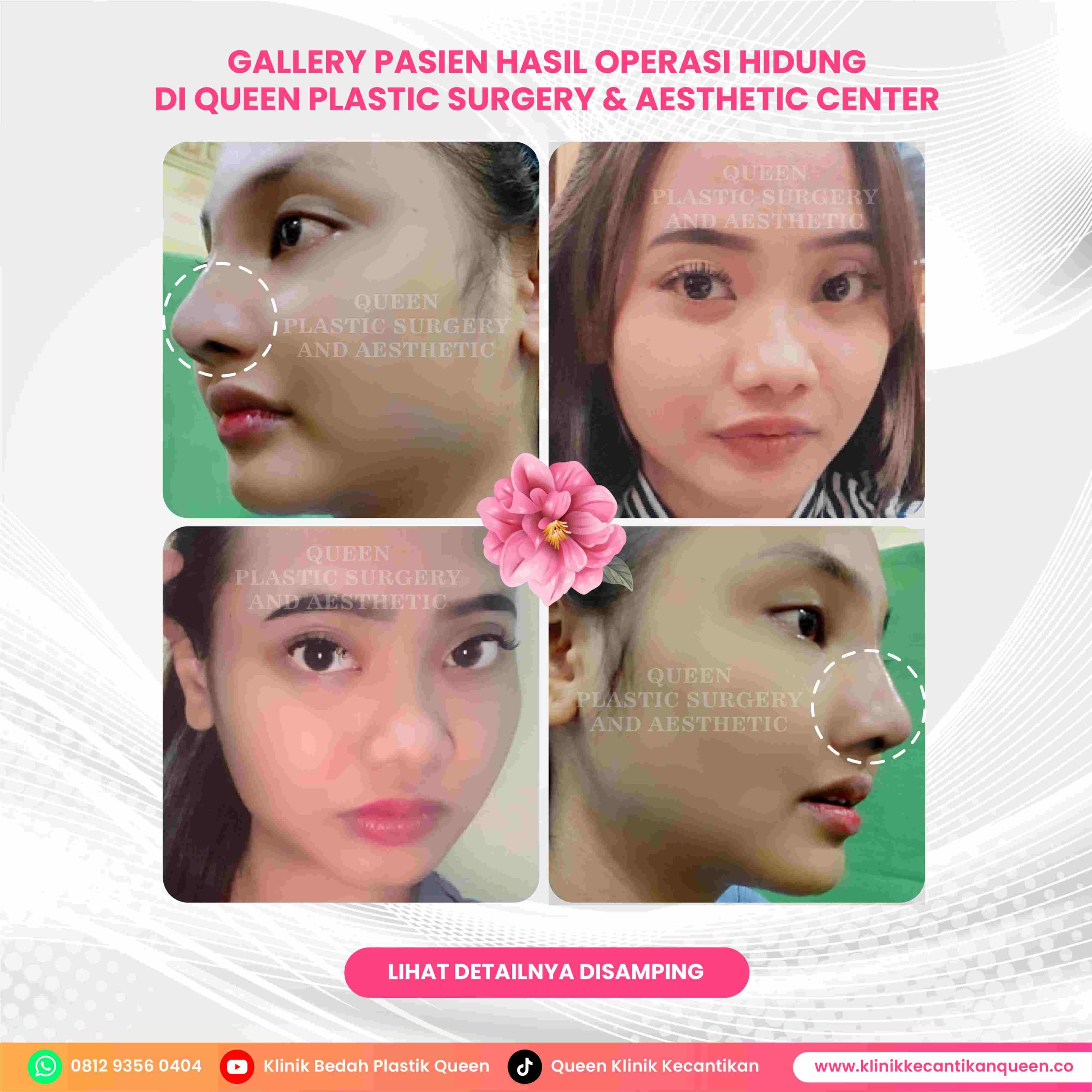Operasi Hidung Rhinoplasty - Klinik Bedah Plastik Queen
