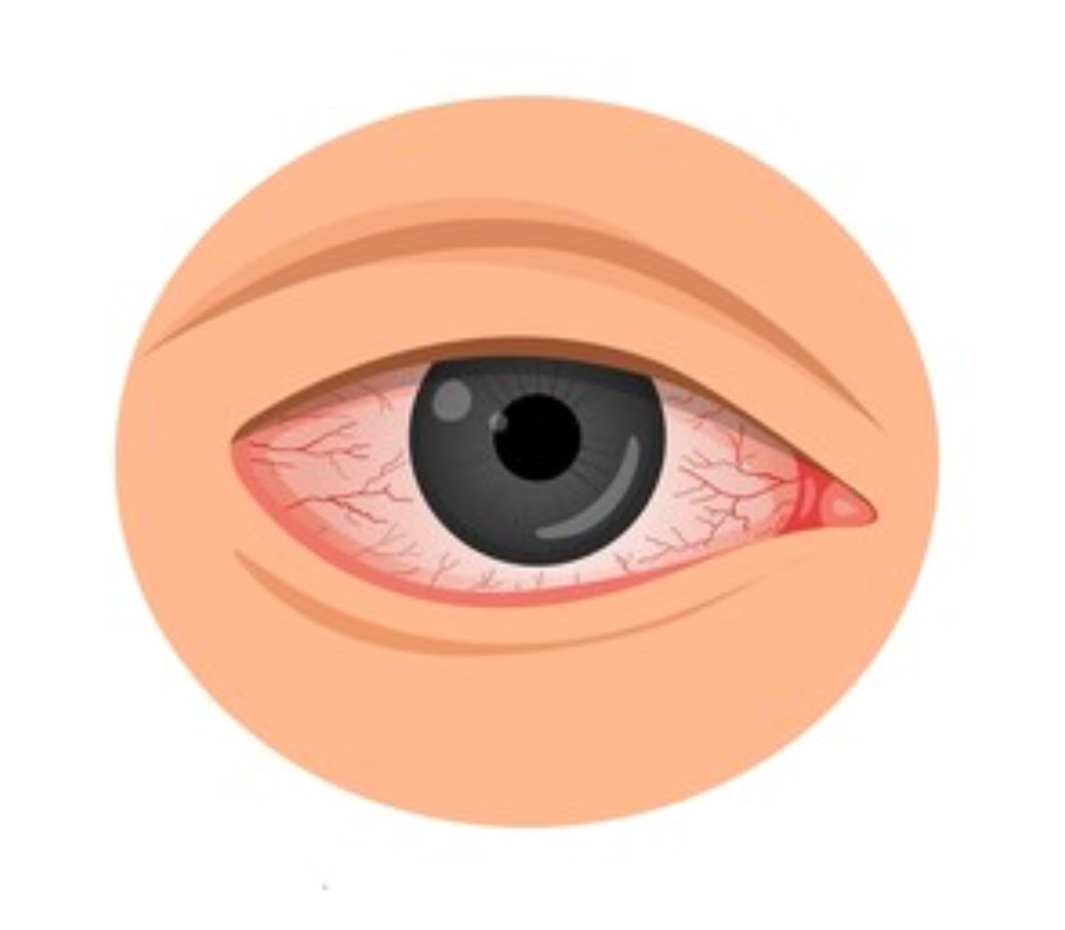 Mata Kering? Kenali Solusi Blepharoplasty untuk Kesehatan Mata ...