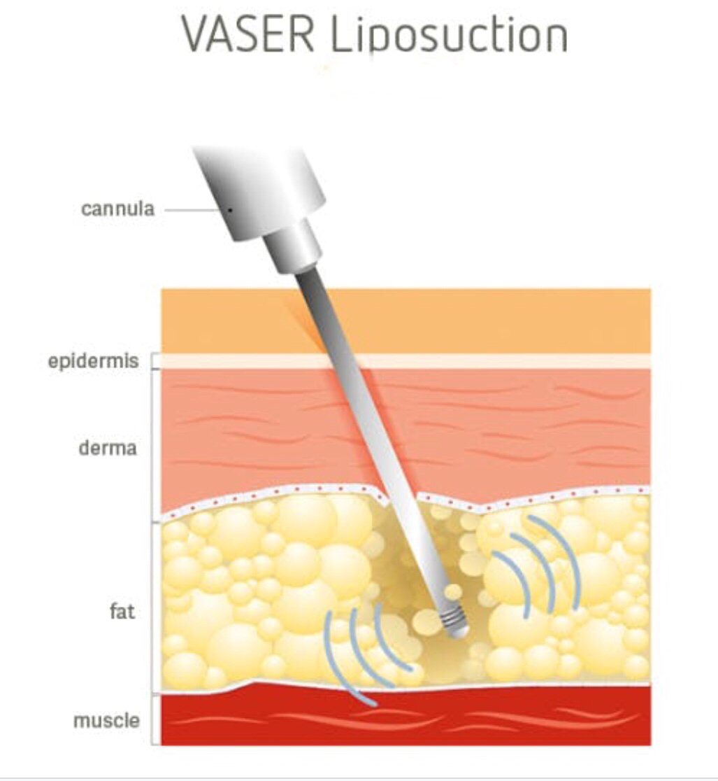 Apa yang Perlu Diketahui tentang Memar Setelah Vaser Liposuction ...