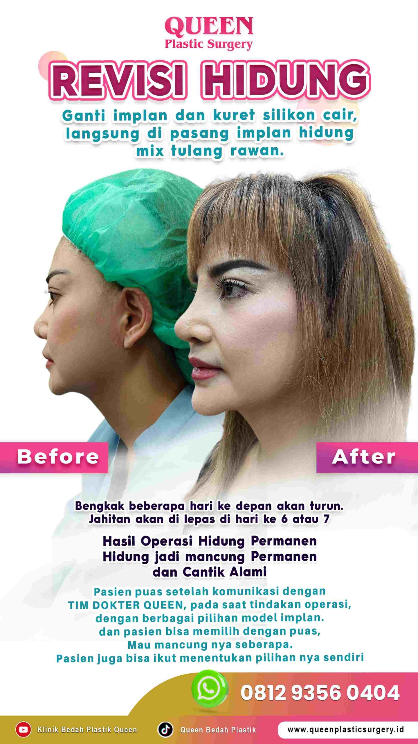 Operasi Hidung Rhinoplasty - Klinik Bedah Plastik Queen