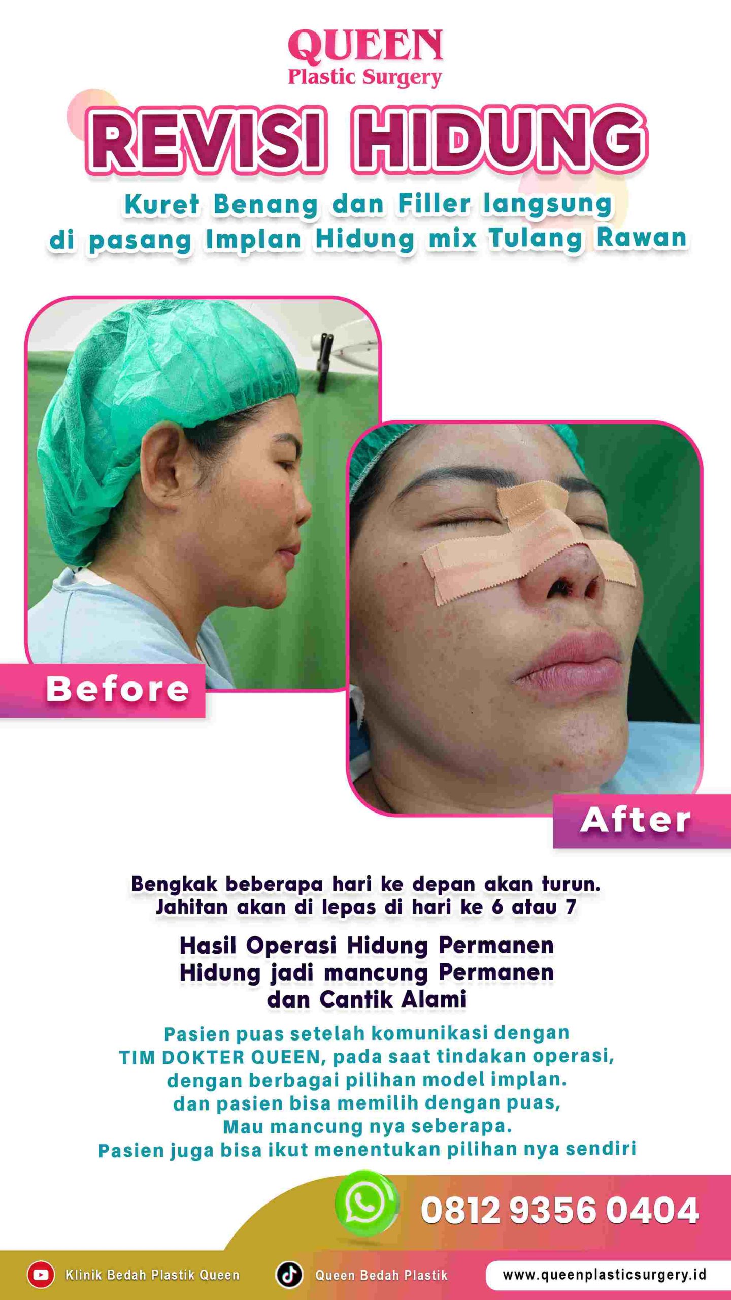 Operasi Hidung Rhinoplasty - Klinik Bedah Plastik Queen