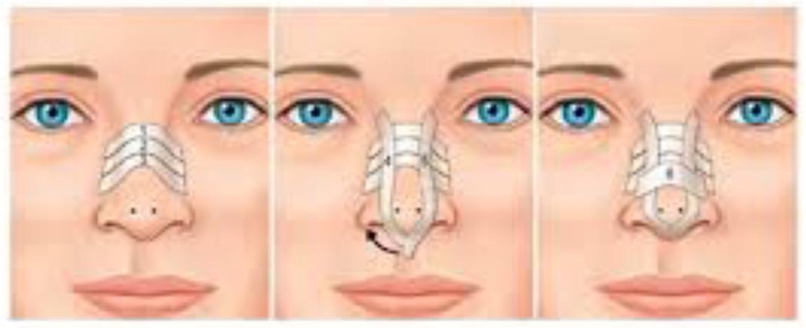 Plester Hidung dalam Proses Penyembuhan Pasca Rhinoplasty - Klinik ...