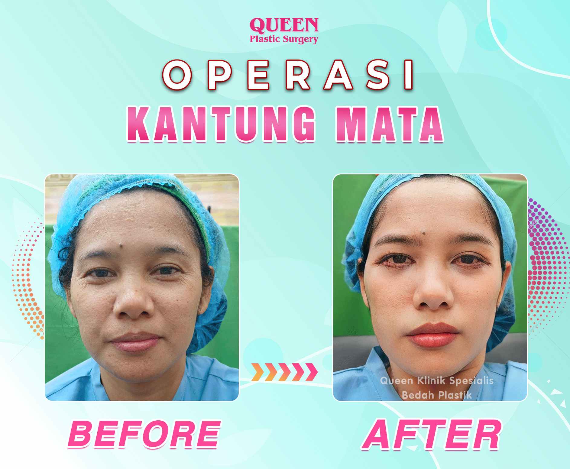 Blepharoplasty - Klinik Bedah Plastik Queen